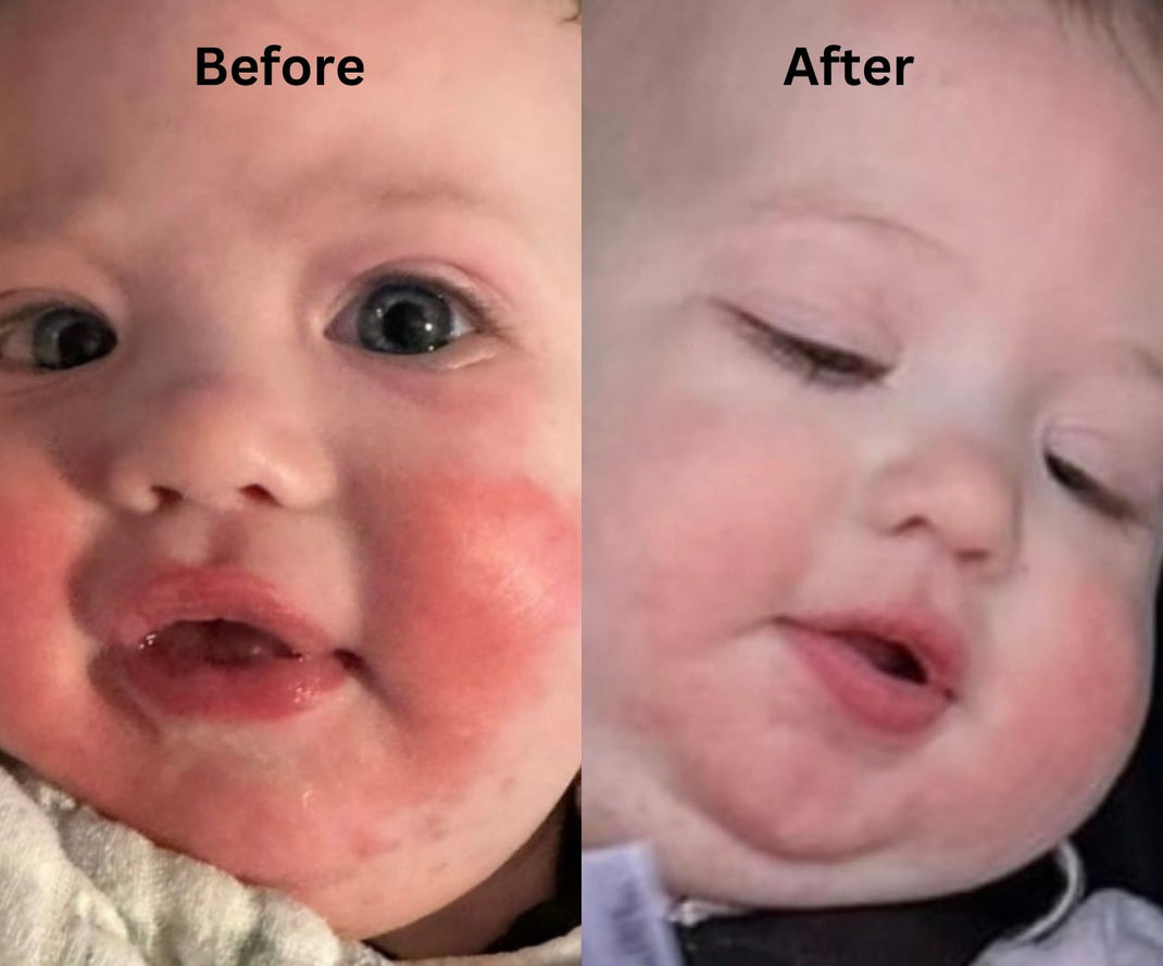 Simply Eden Tallow Skin Transformations – Real Before & After Results