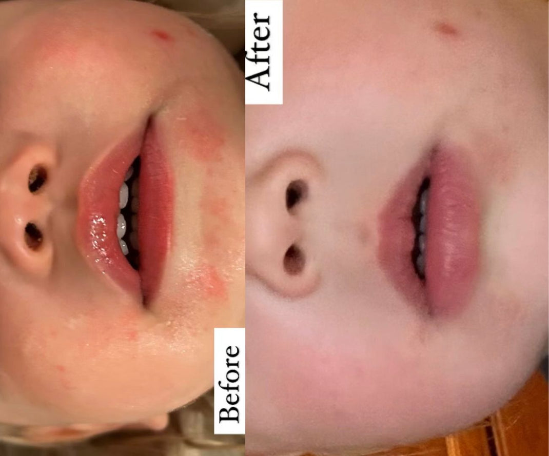 Simply Eden Tallow Skin Transformations – Real Before & After Results