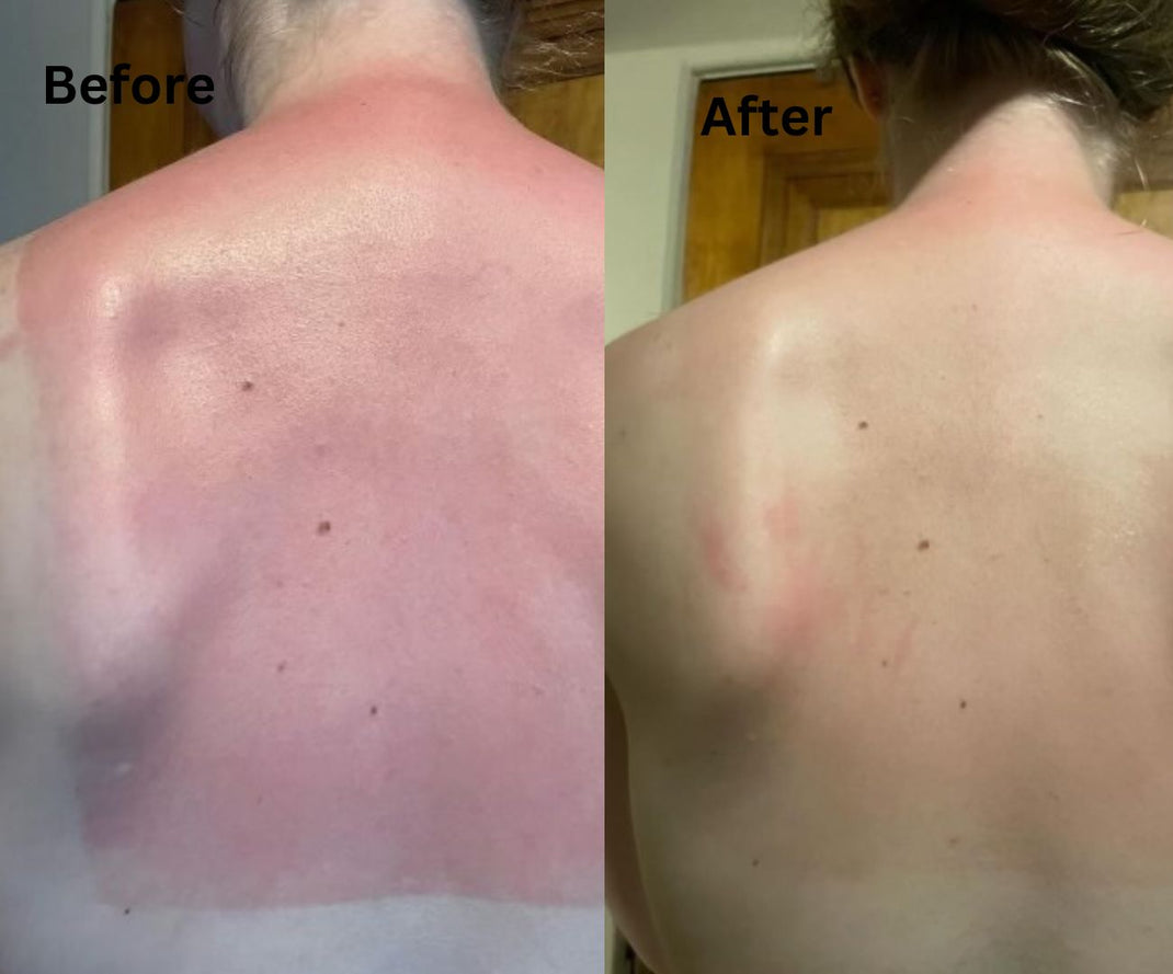 Simply Eden Tallow Skin Transformations – Real Before & After Results